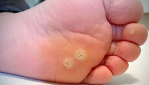 Warts | South Lake Pediatrics